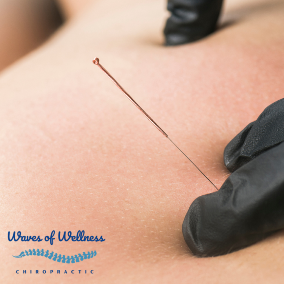 Dry Needling Technique | Waves of Wellness Chiro